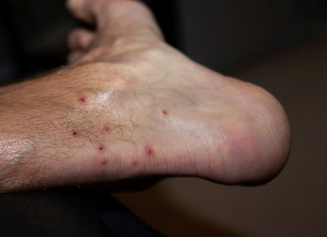 How to Get Rid of Chiggers: 5 Easy Steps to Pest Control - Bob Vila